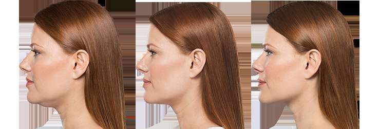 What Is Kybella Used For? | Mirror Mirror Med Spa LA 2022